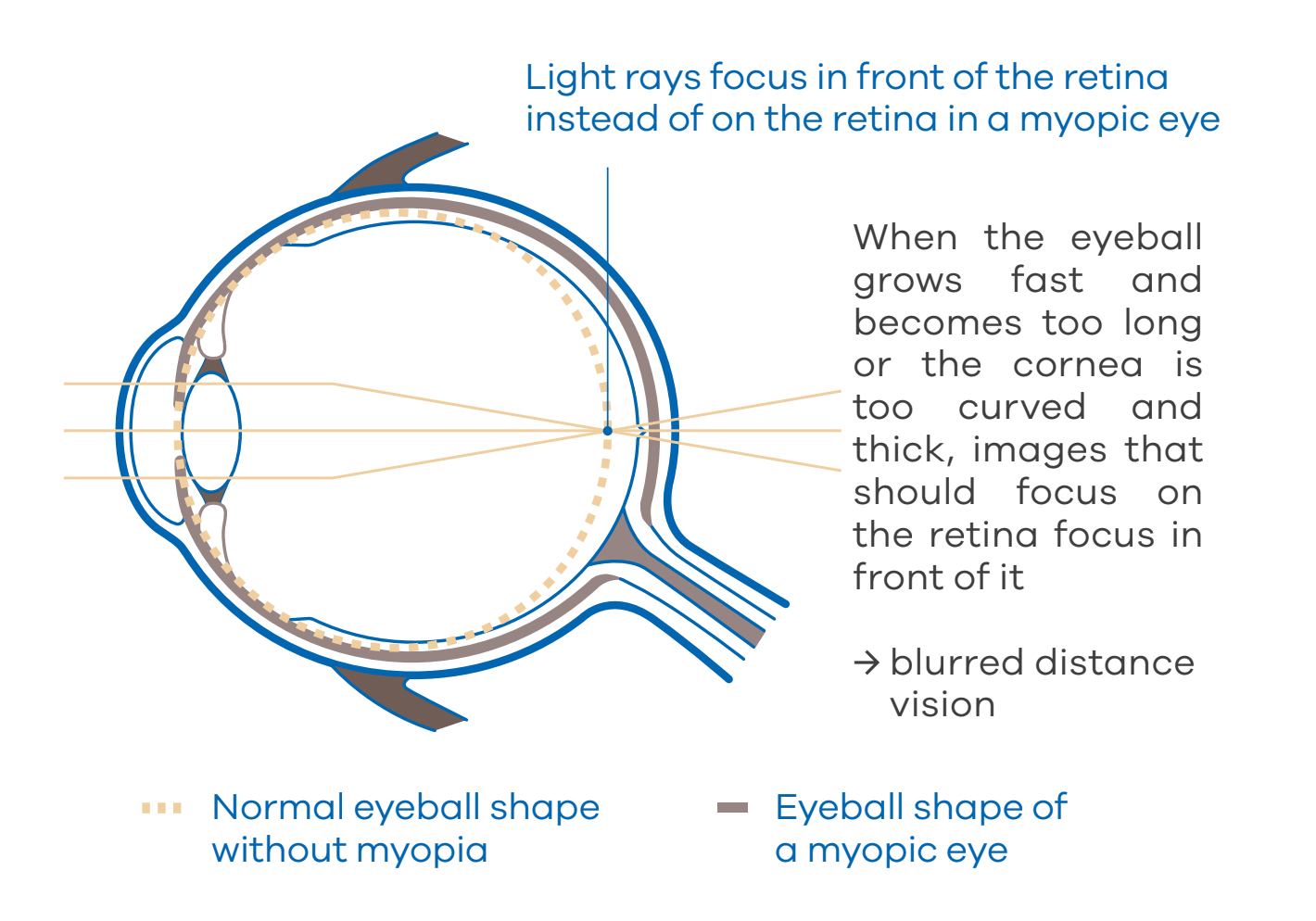 Myopia Management | York Eye Care Clinic